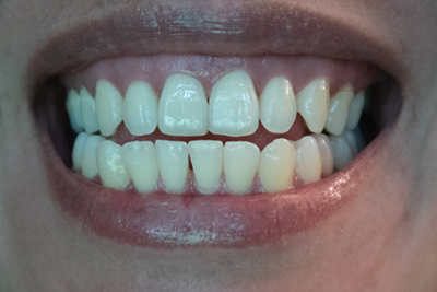 When Should I Be Worried About White Gums Around Teeth? - Modern Dental ...